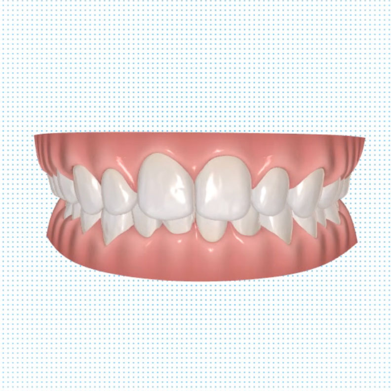 Zenyum Clear Aligners @ Prosmile Dental Clinic | Malaysia